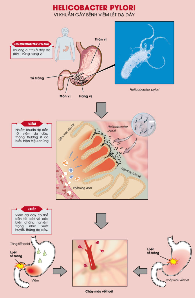 Infographic – Vi khuẩn Helicobacter Pylori – Nguyên nhân gây viêm loét ...